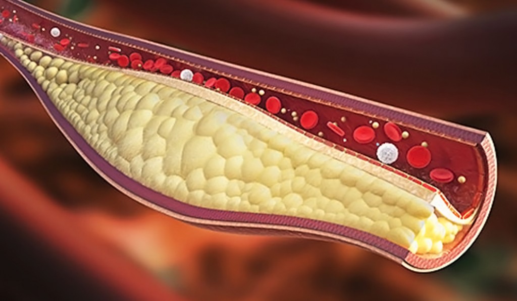Colesterolul mărit - Concentrația mare de colesterol în sânge
